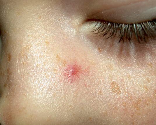 Spider nevi - Medibas – Kunskapsstöd för hälso- och sjukvårdspersonal