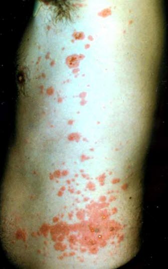 Bullös pemfigoid - Medibas – Kunskapsstöd för hälso- och sjukvårdspersonal