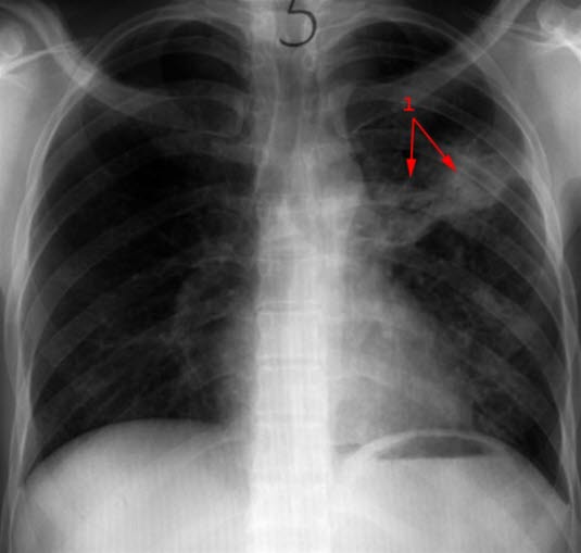 Primär tuberkulos - Medibas – Kunskapsstöd för hälso- och sjukvårdspersonal